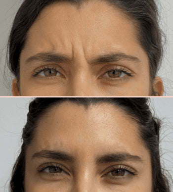 ¿Qué es mejor para el entrecejo: Bótox o Ácido Hialurónico? – Bloome